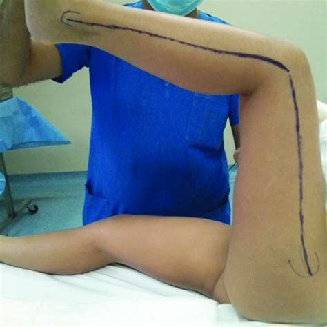 Measurement Of The Popliteal Angle The Angle That The Tested Limb