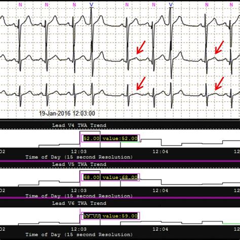 Representative Case Of T‐wave Alternans Twa Measurement Error Due To Download Scientific