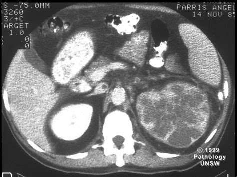 hm3 acute and chronic renal disease practical class station 2 abdominal ct scan