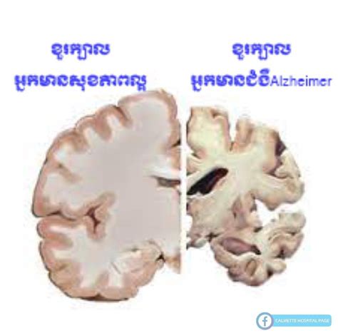 ស្វែងយល់ អំពី កង្វះវីតាមីនd និងផលប៉ះពាល់ទៅលើខួរក្បាល និងប្រព័ន្ធប្រសាទ នគរដ្រេហ្គន