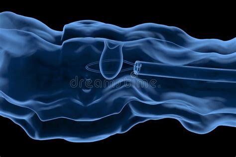 Endoscope Remove Colonic Polyp Stock Illustration Illustration Of Biopsy Inside 157259119