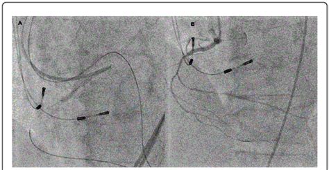 Pci Procedures After Wire Externalization A A Stent Deployed At The Download Scientific