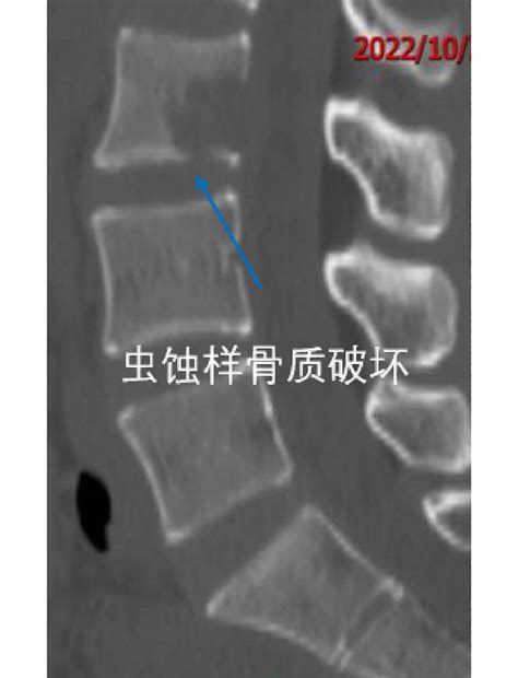 朗格汉斯细胞增生症的ct和mri表现