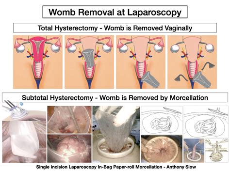 Hysterectomy Anthony Siow