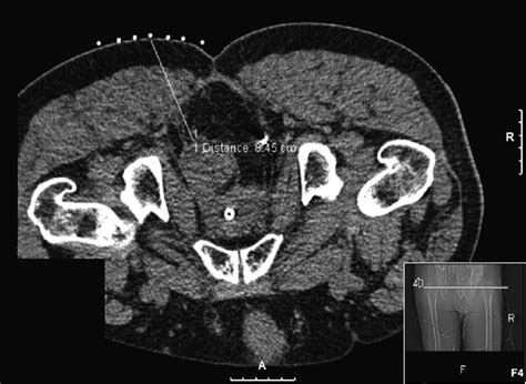 Rfa Probe Positioning Under Ct Guidance Download Scientific Diagram