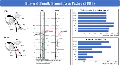 Bundle Branch Block Measurement