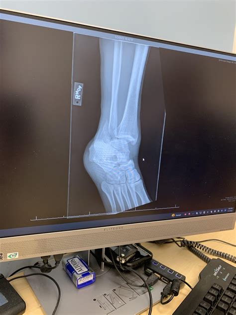 Broken Fibula And Partially Dislocated Tibia R Brokenbones