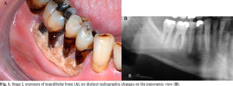 Figure 1 From Proposal For A New Staging System For Osteoradionecrosis