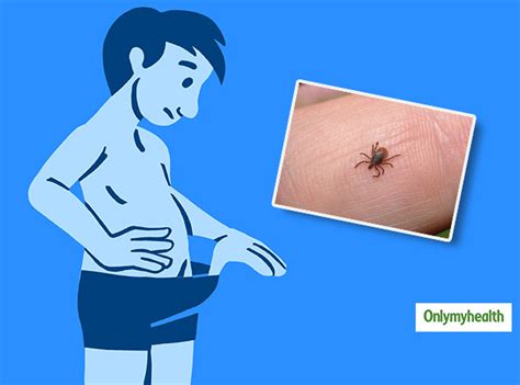 Have You Heard About Pubic Lice Know Everything About These Insects In