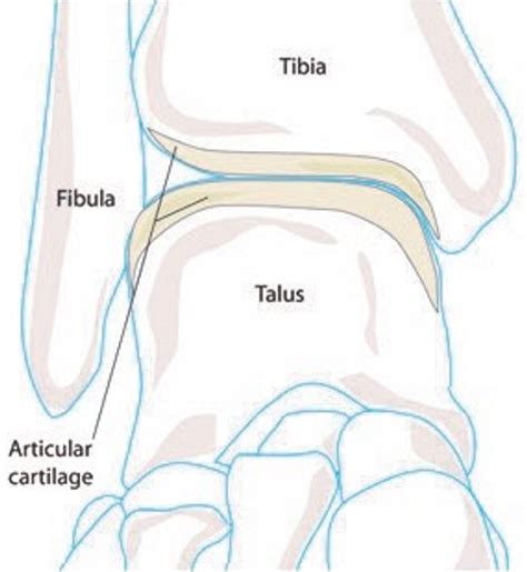 Talar Dome Lesion Foot Management Of Osteochondral Lesions Of The