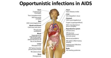 Aids Defining Opportunistic Infections And Neoplasms New