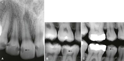 18 Dental Caries Pocket Dentistry