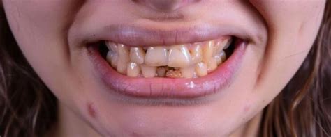 Tanpa Perawatan Ke Dokter Gigi Cewek Ini Unggah Cara Putihkan Gigi