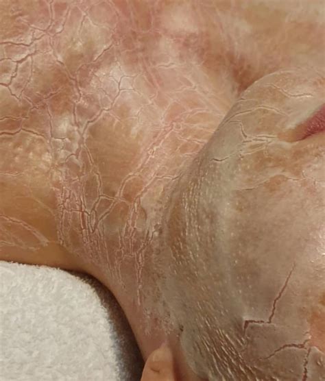 Revive Skin Spa The Dmk Enzyme Therapy Plasmatic