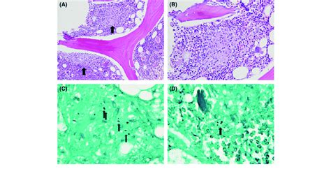 A Bone Marrow Biopsy Showing Hypercellular Bone Marrow With Scattered