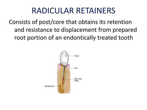 Retainers In Fpd Ppt