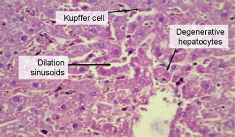 Cross Section In Liver Showing Mild Degenerative Necrosis Hepatocytes