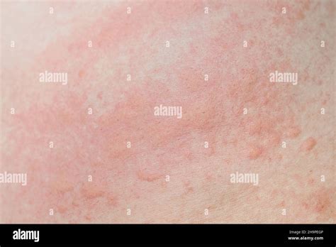 Heat Rash Chest