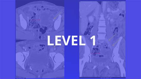 Vascular Access Complications Principles And Practice For The Savvy Learner Dr Mikhail