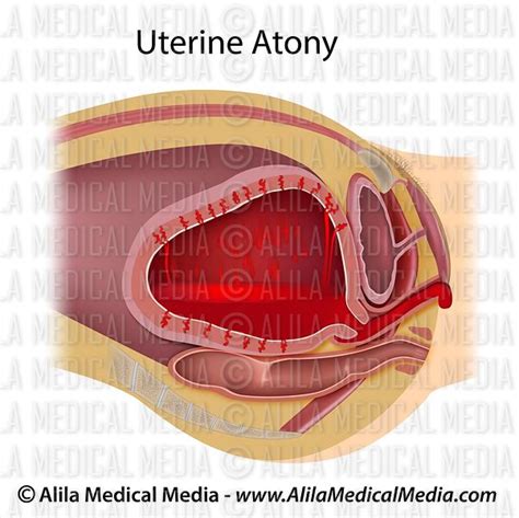 Alila Medical Media Uterine Atony Lying Down Position Medical