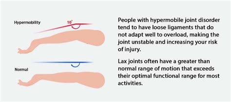 Managing Joint Laxity In Hypermobility Spectrum Disorders