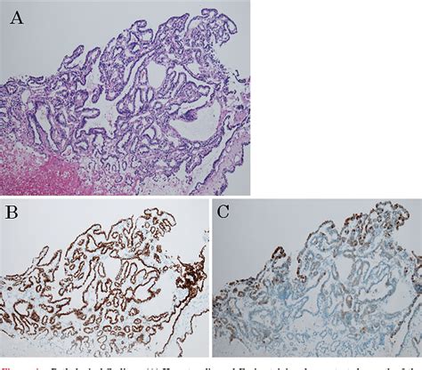 Figure From Choroid Plexus Metastasis Of Follicular Thyroid Carcinoma Diagnosed Due To