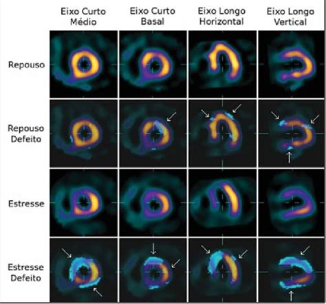 Tomographic Sections Representative Of Myocardial Perfusion Spect Of A Download Scientific