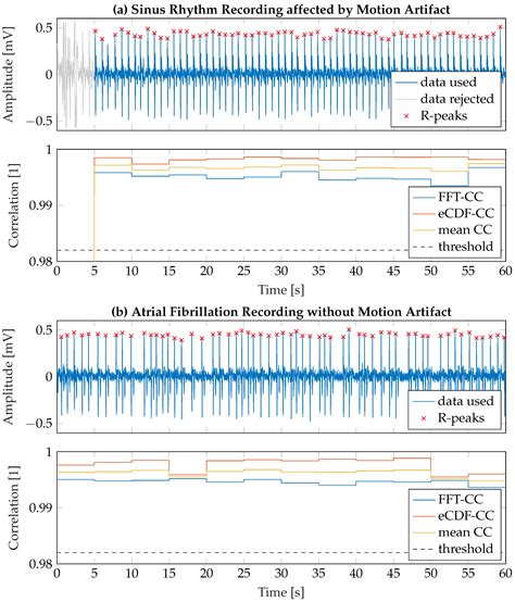 Automated Signal Quality Assessment Of Single Lead Ecg Recordings For Early Detection Of Silent