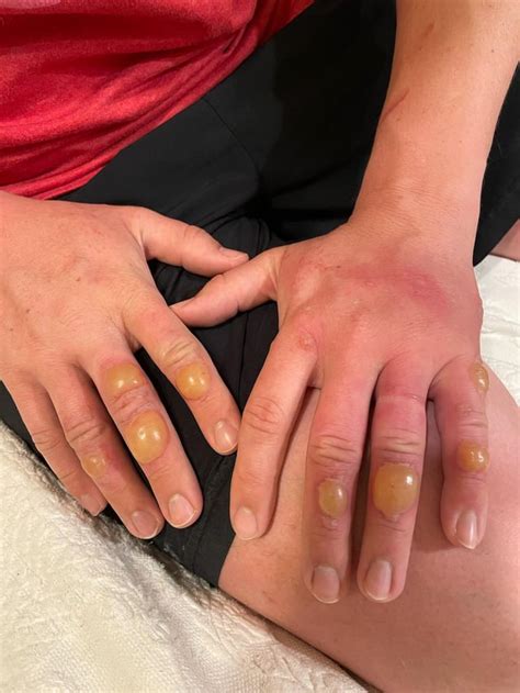 [sun Care] Psa Lime Juice Can Make You Extremely Sensitive To The Sun And Result In