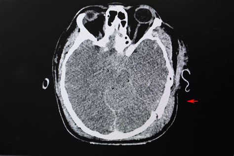 Basal Skull Fracture Ct Scan At Alexander Feakes Blog