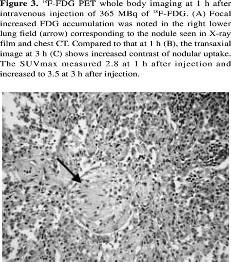 Pathological Inspection Hematoxylin Eosin Stain Reveals Organizing
