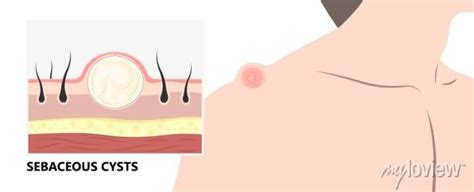 Shoulder With Inflammation Bumps Under The Skin Sebaceous Cyst Posters