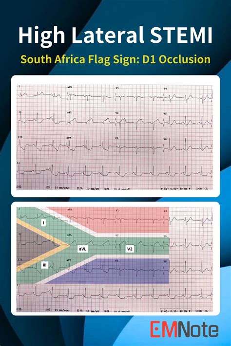 The Heart High Lateral Stemi South Africa Flag Sign