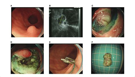 The Conventional Endoscopic Submucosal Dissection Of A Gastric Gist Download Scientific