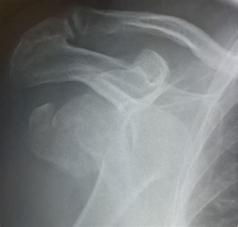 Anterior Shoulder Fracture Dislocation Orthogate