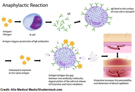 Anaphylactic Shock Nclex Review