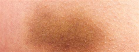 How To Treat A Hematoma After Spine Surgery Minnesota Spine Surgeon