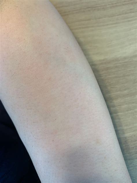 팔에 빨간 점 지식in