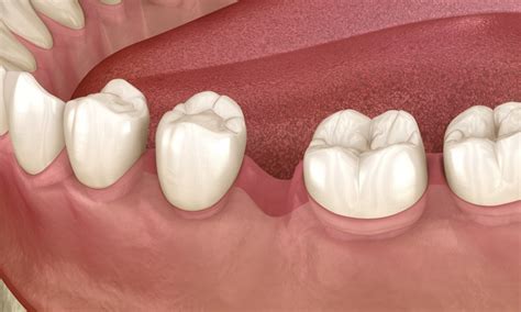 Teeth Shifting Why Teeth Shift And How To Stop It