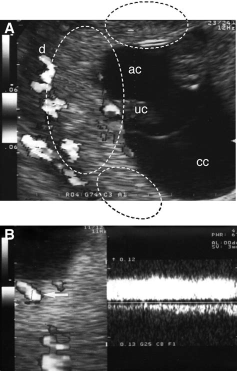 Trophoblastic Oxidative Stress In Relation To Temporal And Regional