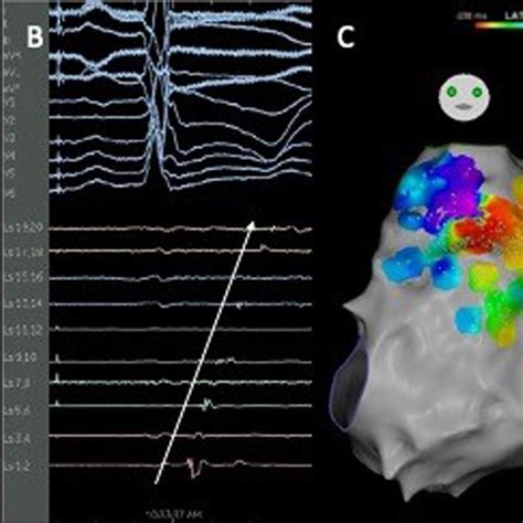 Two Predominant Scar Patterns Visualized With Lge On Cmr Scar Outlined