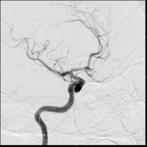 Coil Embolization Of Aneurysm Angiogram Stock Image C039 4157 Science Photo Library