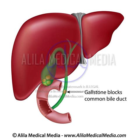 Alila Medical Media Gallstone Blocks Common Bile Duct Medical