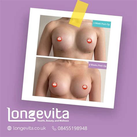 Uneven Breasts Post Breastfeeding