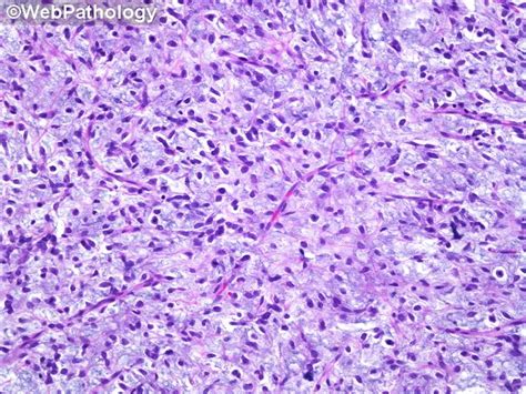 Myxoid Liposarcoma Additional Images
