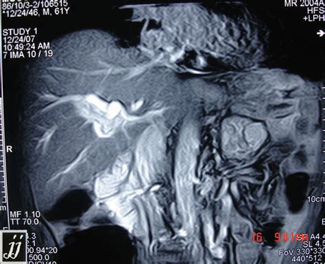 Ercp And Mrcp Radiopaedia