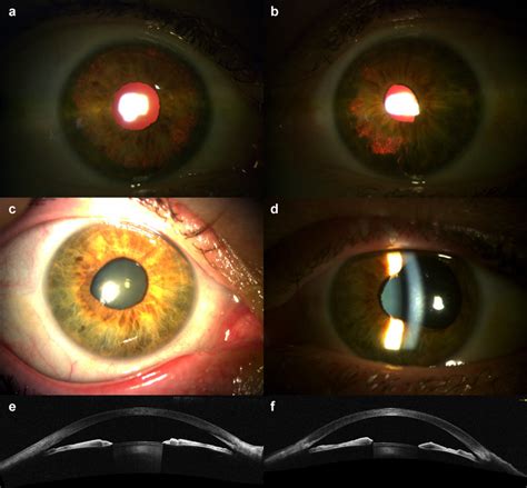 Bilateral Acute Iris Transillumination Following Systemic Moxifloxacin