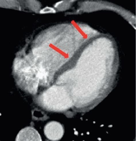 Myocardial Ischemia Radiology Key