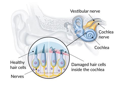 Cochlear Nerve Damage
