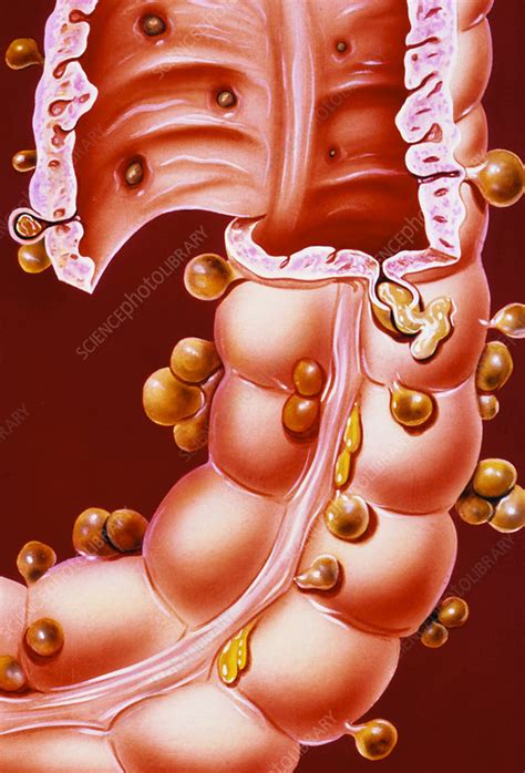 Diverticulitis